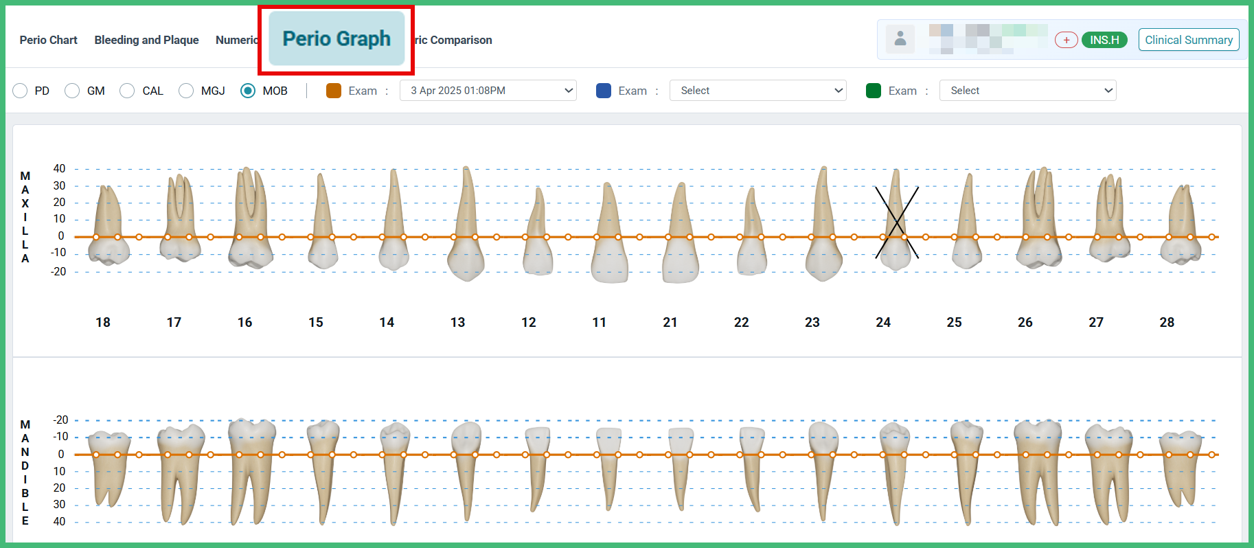 Description of Gum Measurements for Periodontal Charting – CareStack