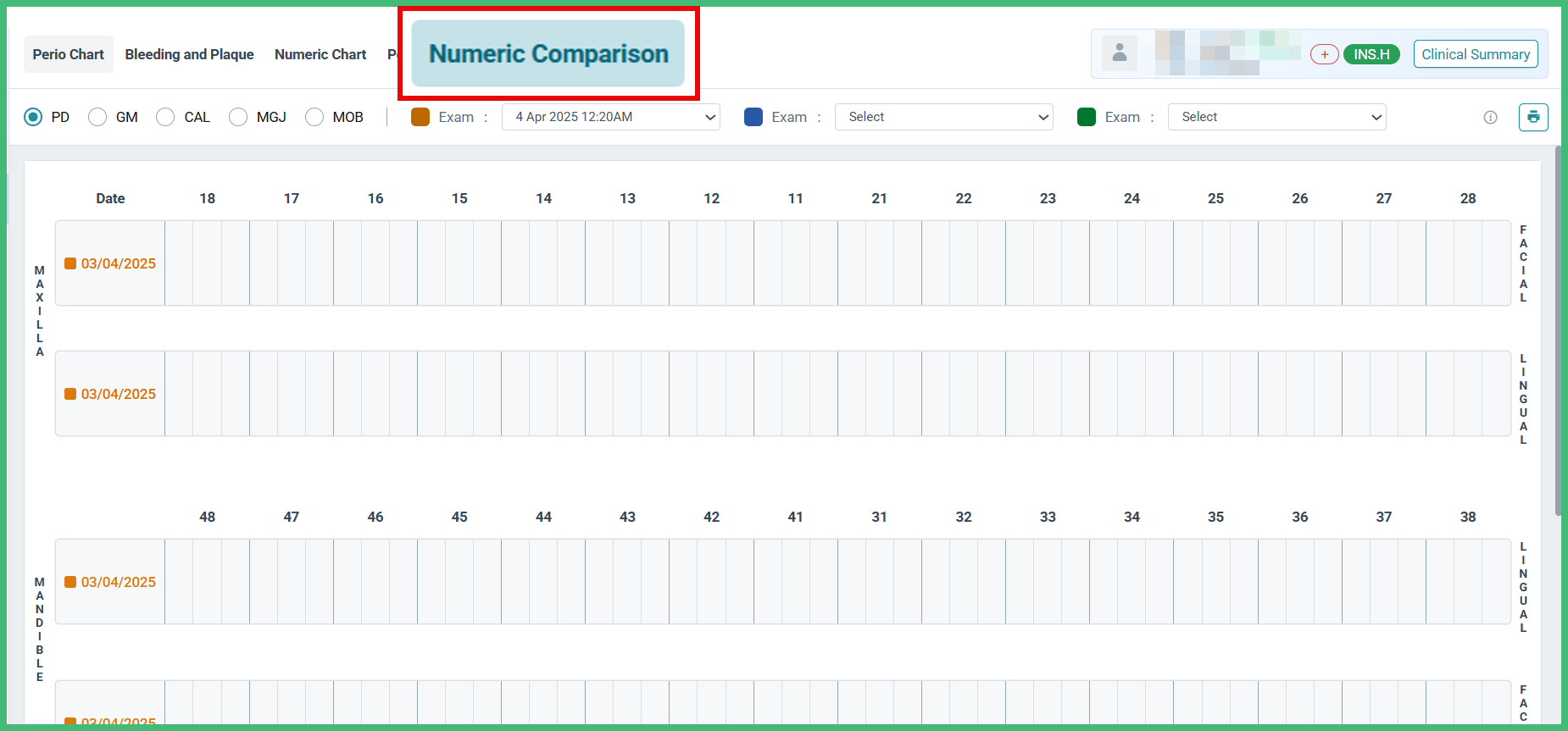 Description of Gum Measurements for Periodontal Charting – CareStack