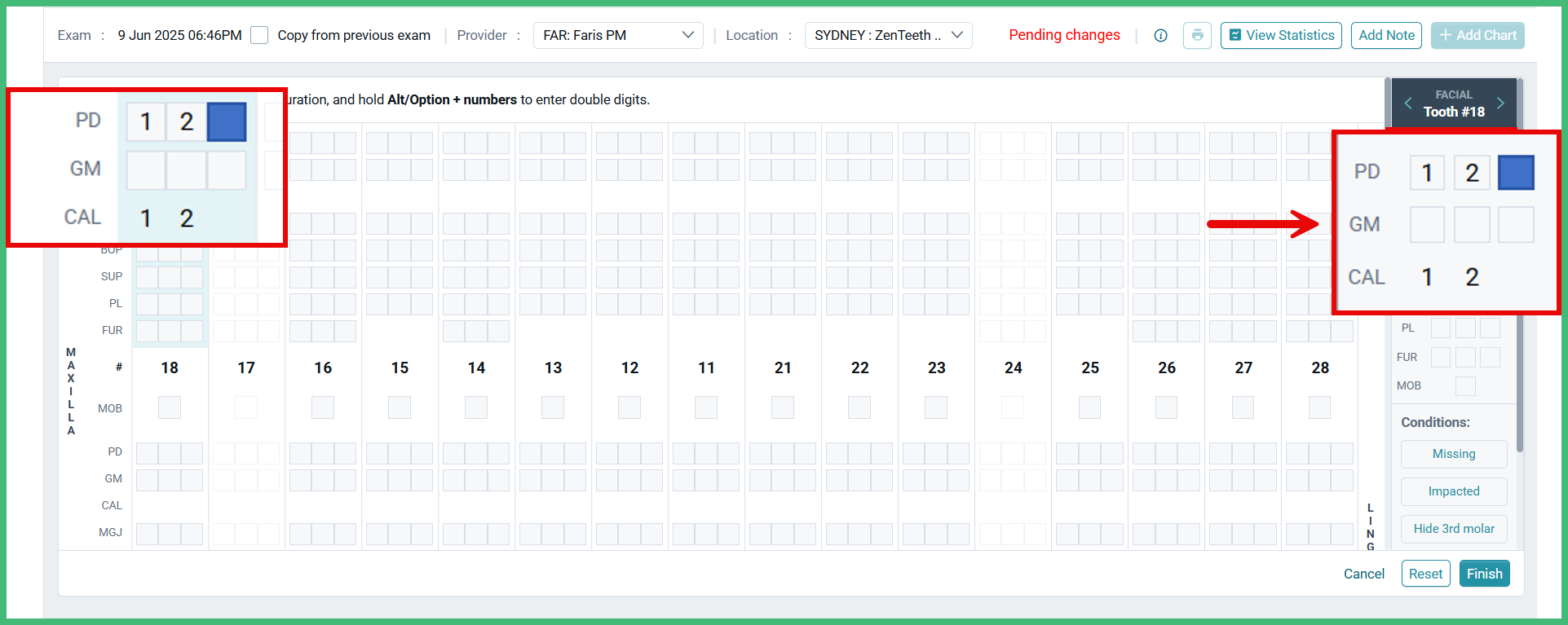 Description of Gum Measurements for Periodontal Charting – CareStack